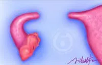 Tubal Ligation - Pomeroy Technique