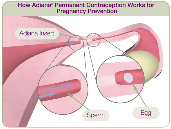 Can Adiana Be Reversed? Is Pregnancy Possible After Adiana Reversal?